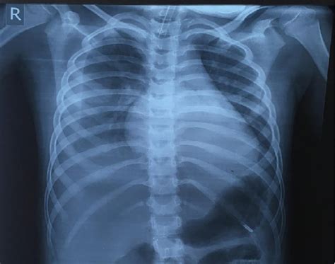 Chest X Ray Shows Pleural Effusion In Both The Right And Left Lungs