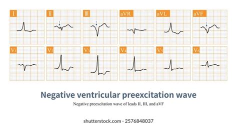 Pathway Myocardial Infarction Photos Images And Pictures Shutterstock