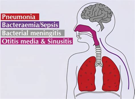 Pneumococcal Disease Avin Darou