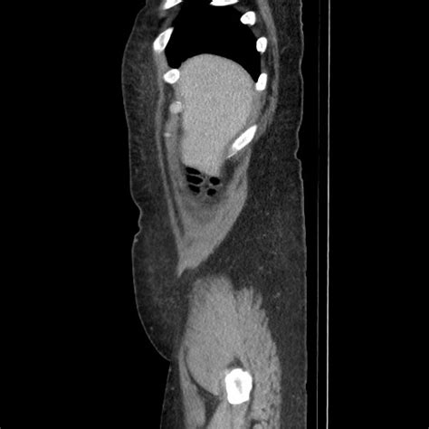 Filetransmesenteric Internal Hernia Duodenal Switch Radiopaedia