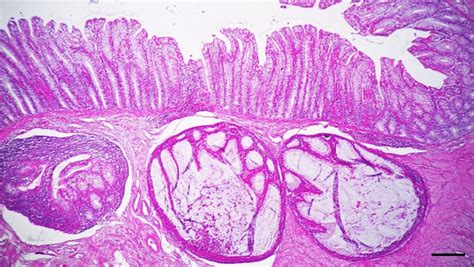 Ileum Cryptitis And Herniation Of The Crypts Into The Submucosa The Download Scientific