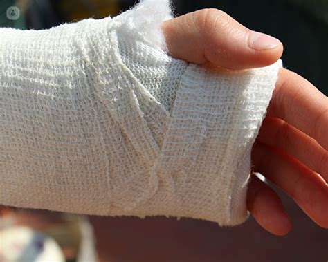 Scaphoid Fracture Cast