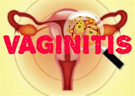 Acute Vaginitis Introdution With Homeopathic Management Hds