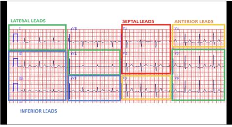 Ekg Leads Flashcards Quizlet