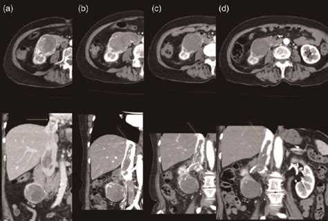 Computed Tomography Ct During Neoadjuvant Treatment Ct Scan Showed Download Scientific