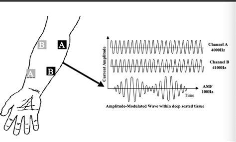 Ifc Vs Tens Electrical Stimulation For Pain And Swelling