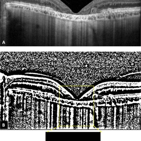 Structural Optical Coherence Tomography Oct And Choroidal Vascularity Download Scientific