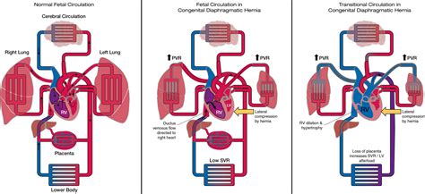 Left Congenital Diaphragmatic Hernia