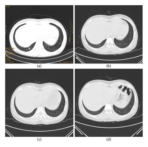 A Computed Tomography Imaging Of An Asymptomatic Carrier Who Download Scientific Diagram