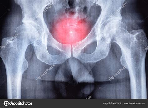 Ray Mri Mrt Human Spine Defects Bones Vertebrae Medical Treatmant