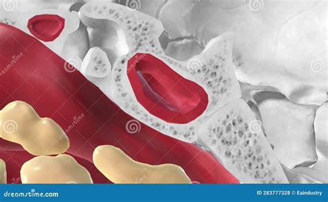 Sinusitis Is An Inflammation Or Swelling Of The Tissue Lining Your