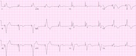 Pacer Mnemonic Approach To Pacemaker Patients Ecg Cases Em Cases