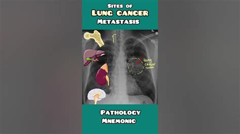 Sites Of Lung Cancer Metastasis Easy Mnemonic For Usmle Neet Pg