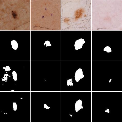 Mask2lesion Mask Constrained Adversarial Skin Lesion Image Synthesis Paper And Code Catalyzex