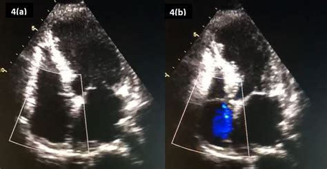 Case Report Co Existing Sinus And Atrio Ventricular Node Dysfunction