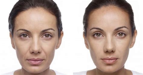 Juvederm Volite Treatments In London Achieve Skin Vitality