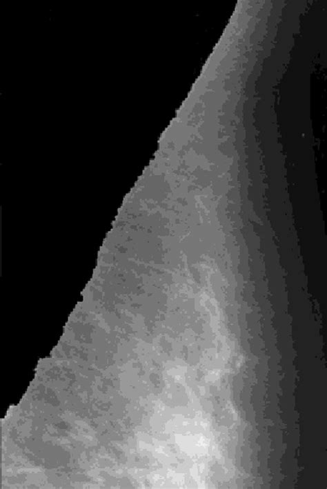 Pectoral Muscle Suppressed By Proposed Seeded Region Growing Algorithm