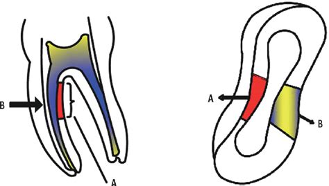 Figure 1 From Detection Of Root Perforations Using Conventional And