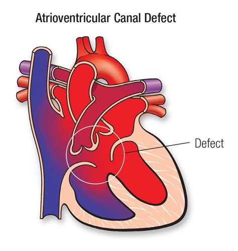 Complete Atrioventricular Canal Defect Cavc American Heart Association