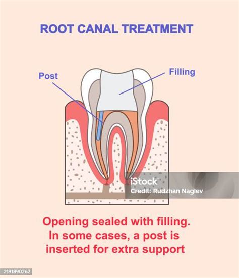 근관 치료 인포그래픽 치과 및 구강학 건강 관리 및 의학 의학 교육 자료 평면 벡터 일러스트 레이 션 건강관리와 의술에 대한