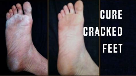 Ways To Heal Cracked Feet Online