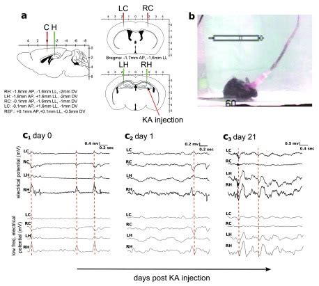 Longitudinal Variations Of Brain Functional Connectivity A Case Report