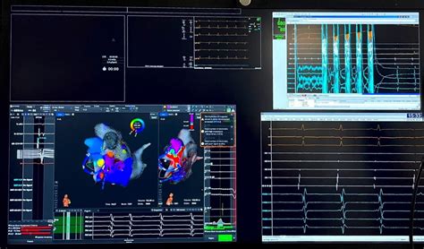 The First In Poland Rhythmia Hdx Guided Pfa Ablatio For Resistant