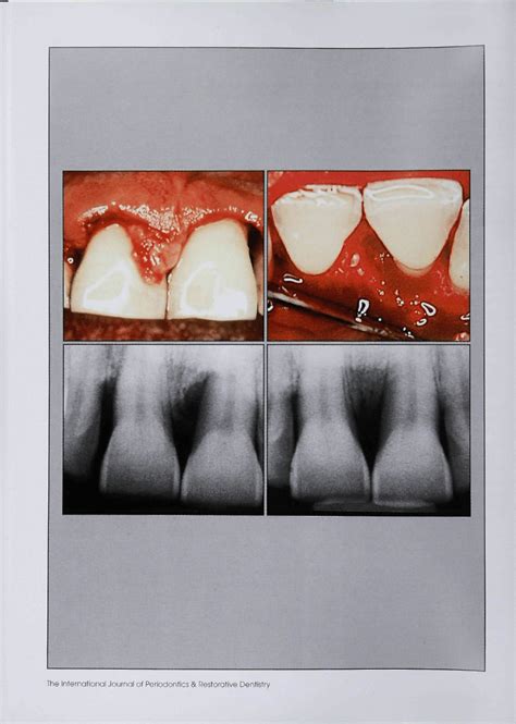Pdf Guided Tissue Regeneration In Human Class Ii Furcations And Interproximal Infrabony