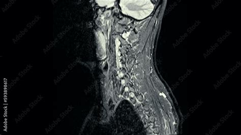 Magnetic Resonance Images Mri Of Cervical Spine Sagittal C5 C6