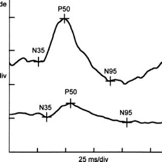 PERGP50 Wave Latency Delay And Reduced Amplitudes Of P50 And N95 Wave