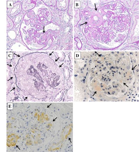 Histology Of The Renal Biopsy Specimen A A Representative
