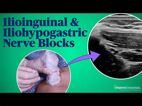 Iliohypogastric Nerve Block