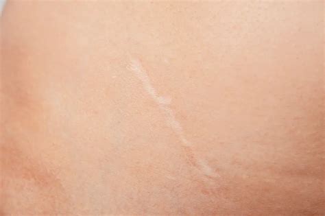 Appendicitis Symptoms In Women STD GOV Blog