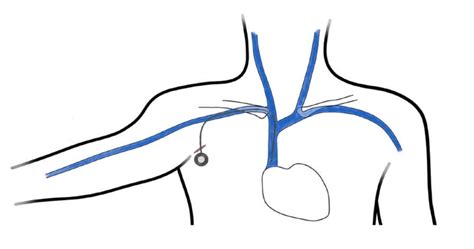 Portacaths Yorkshire Vascular Access Expert Care For Your Venous