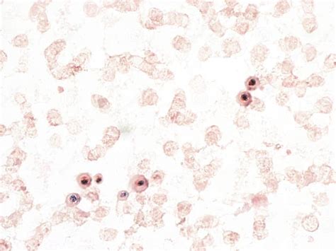 Cryptococcus In Peripheral Blood Smear Gram Stain Stock Image Image
