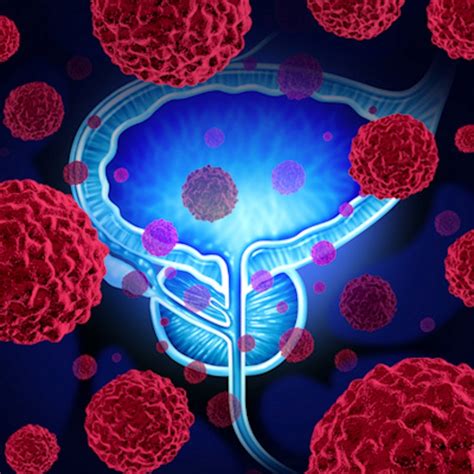 Abstinence Before Prostate Mri Offers Benefits In Over 60s Auntminnie