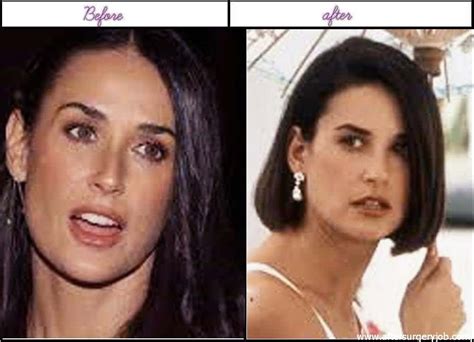 Plastic Surgery Pics Of Demi Moore She Looks More Beautiful In Advance