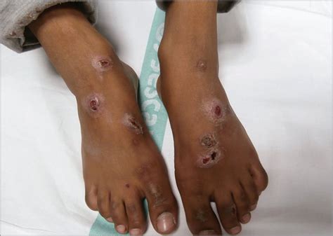 Diphtheria Latest News Breaking Headlines And Top Stories Photos