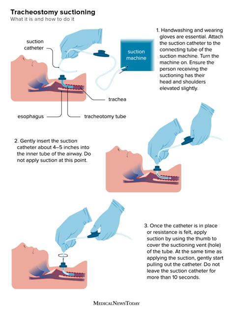 Steps For Suctioning A Tracheostomy Tube At Steven Cheryl Blog