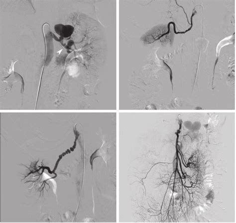 Selective Visceral Angiography A Multiple Saccular Aneurysms Are