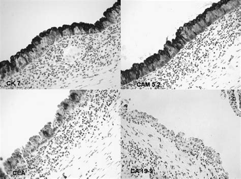 Giant Epidermoid Cyst Within An Intrapancreatic Accessory Sp Pancreas