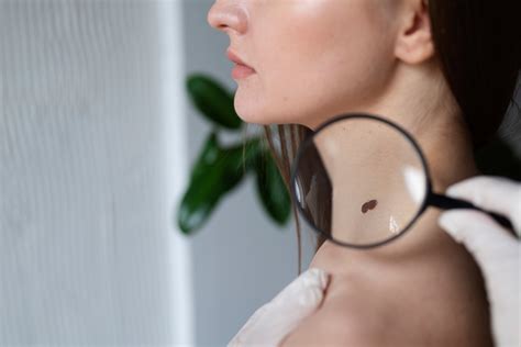 Papiloame Pe Gât Cauze și Tratament R1 Clinic