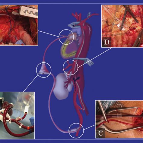 Schematic View Of Left Heart Bypass A 20 Fr Cannula Is Inserted In
