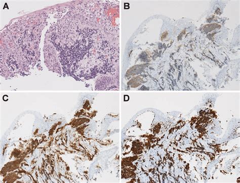 A The Type 2 Tumor Had Squamous Cell Carcinoma In The Mucosal