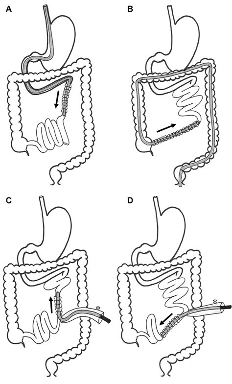 Intraoperative Enteroscopy Gastrointestinal Endoscopy Clinics