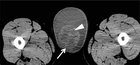 Management Of Testicular Leydig Cell Tumor A Case Report Medicine