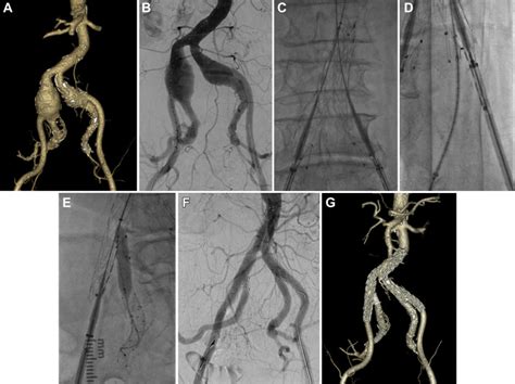 Endovascular Repair Of Aortoiliac Or Common Iliac Artery Aneurysm Using