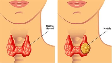 Nódulos Tiroideos Qué Son Diagnóstico Y Tratamiento Doctor Online