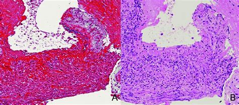 Photomicrographs Of The Resected Aneurysmal Wall A The Section Download Scientific Diagram