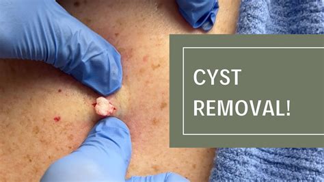 Cyst Removal Surgery Cost Without Insurance Sebaceous Treatment